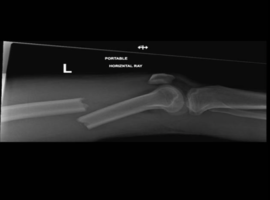 Femoral Shaft Fracture with Ipsilateral Knee Dislocation and Popliteal ...